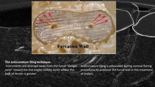 ANTICURVATURE FILING TECHNIQUE ENDO.pptx
