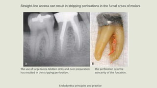 ANTICURVATURE FILING TECHNIQUE ENDO.pptx