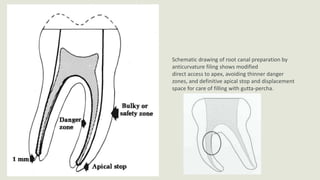 ANTICURVATURE FILING TECHNIQUE ENDO.pptx