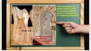 ANTICURVATURE FILING TECHNIQUE ENDO.pptx