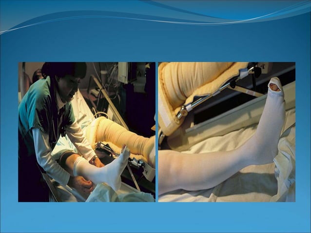 ANTI EMBOLIC STOCKING | PPT