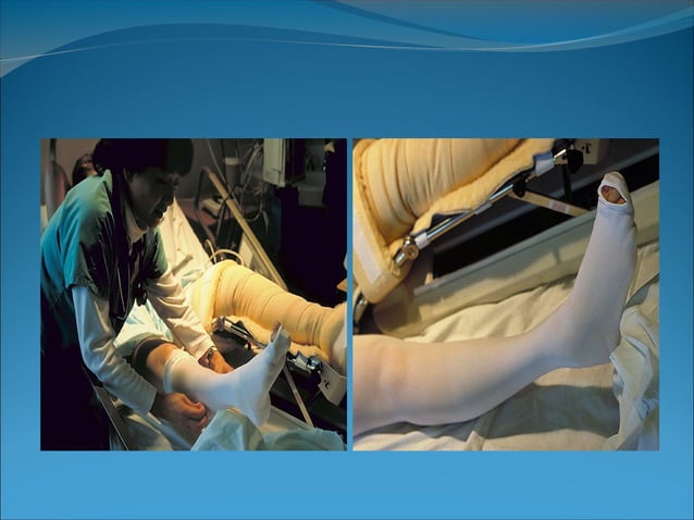 antiembolicstocking-220905041030-88a794a2.ppt