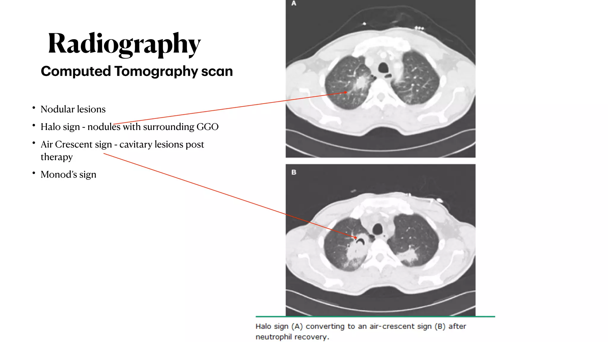 Fungal Infections in the Intensive Care Unit and Antifungals | PDF