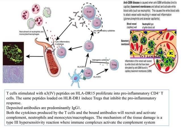 ANTI GBM DISEASE final hellllo hiiiii.pptx