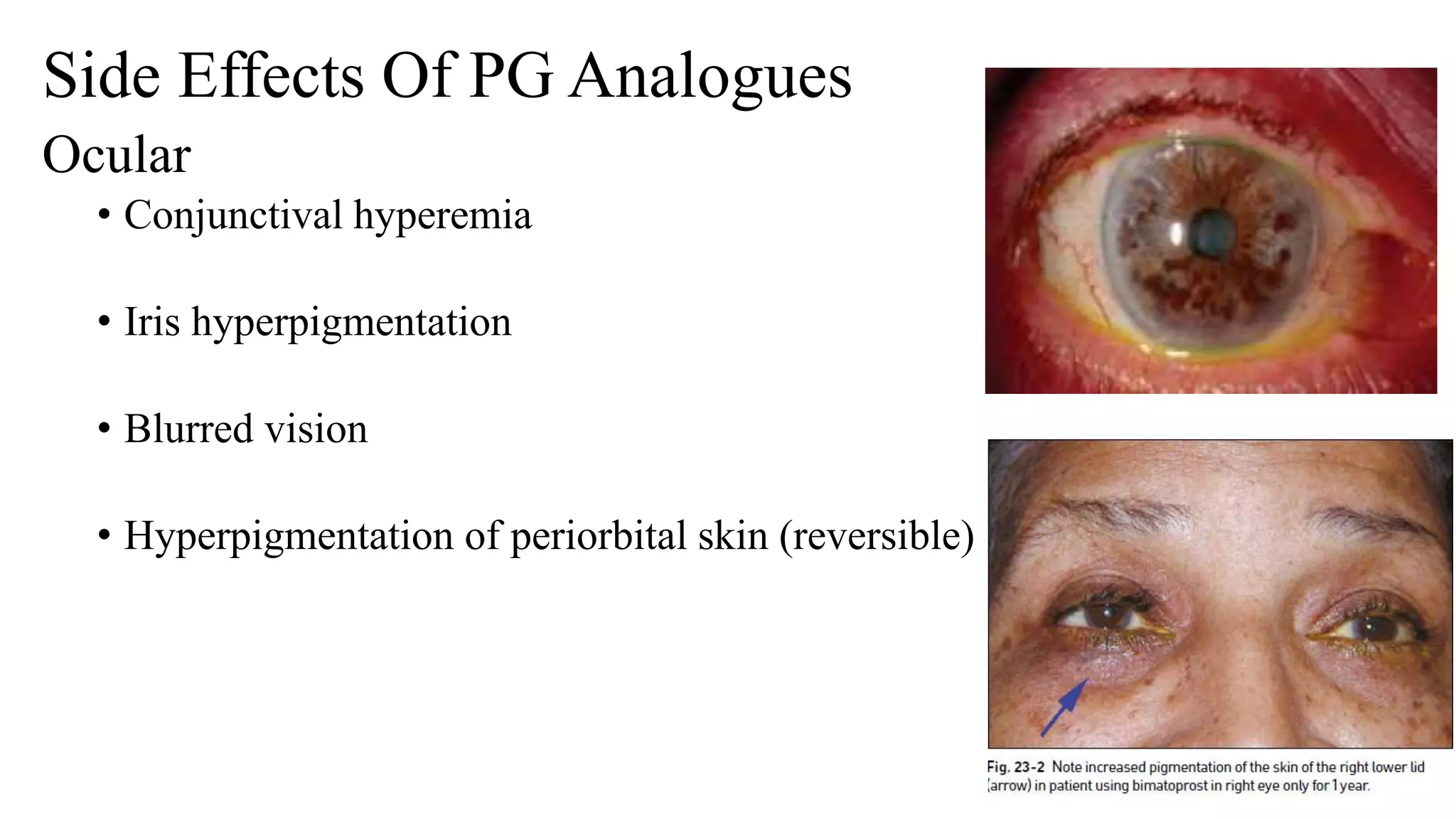 ANTI GLAUCOMA DRUGS.pptx