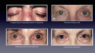 ANTIGLAUCOMA DRUGS by DR. ZAW MIN HTET | PPTX