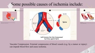 Anti Ischemic, definition, causes, classification, pathophysiology | PPTX