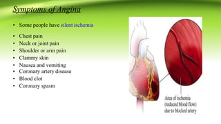Anti-Ischemics | Mechanism | Ischemia | Signs & Symptoms | PPTX
