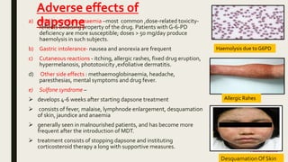 Antileprotic drugs new | PPTX