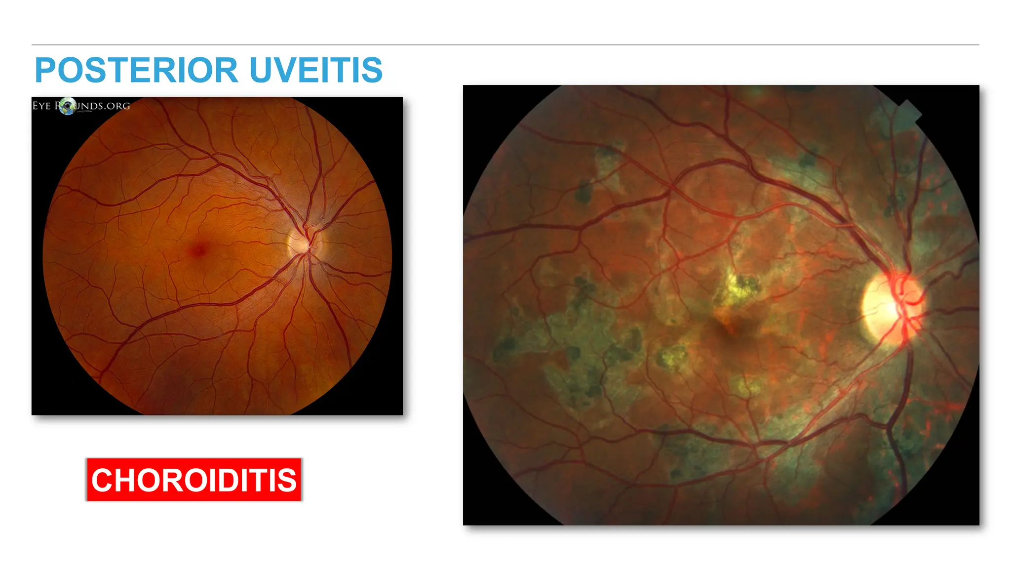 Uveitis: Clinical Features & Investigations | PDF | Eye and Vision ...
