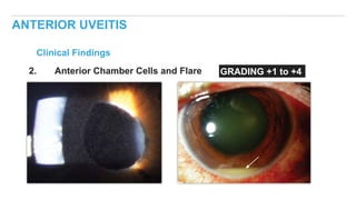 Uveitis: Clinical Features & Investigations | PDF
