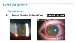 Uveitis: Clinical Features & Investigations | PDF
