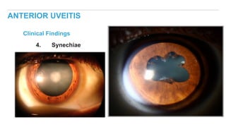 Uveitis: Clinical Features & Investigations | PDF