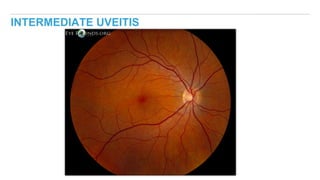 Uveitis: Clinical Features & Investigations | PDF