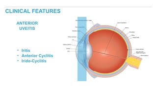 Ant Int Post Uveitis Ant Int Post Uveitis | PPT