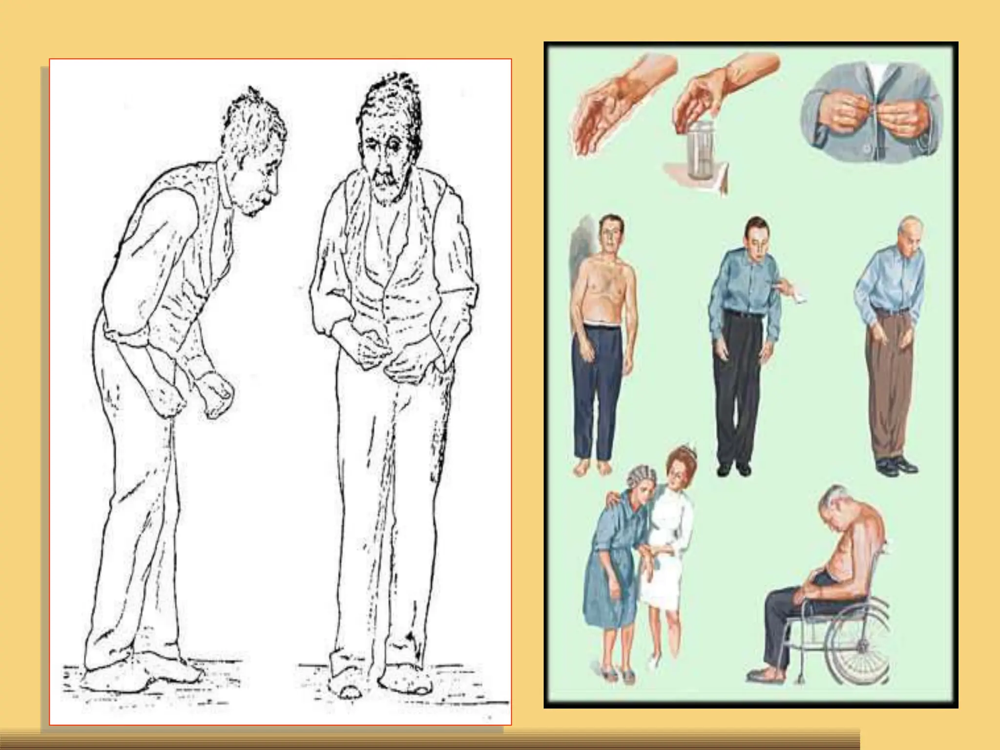 antiparkinson drug-Dopamine precursors,levodopa,cabidopa,bromocriptyne ...