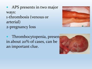 Antiphospholipid | PPTX