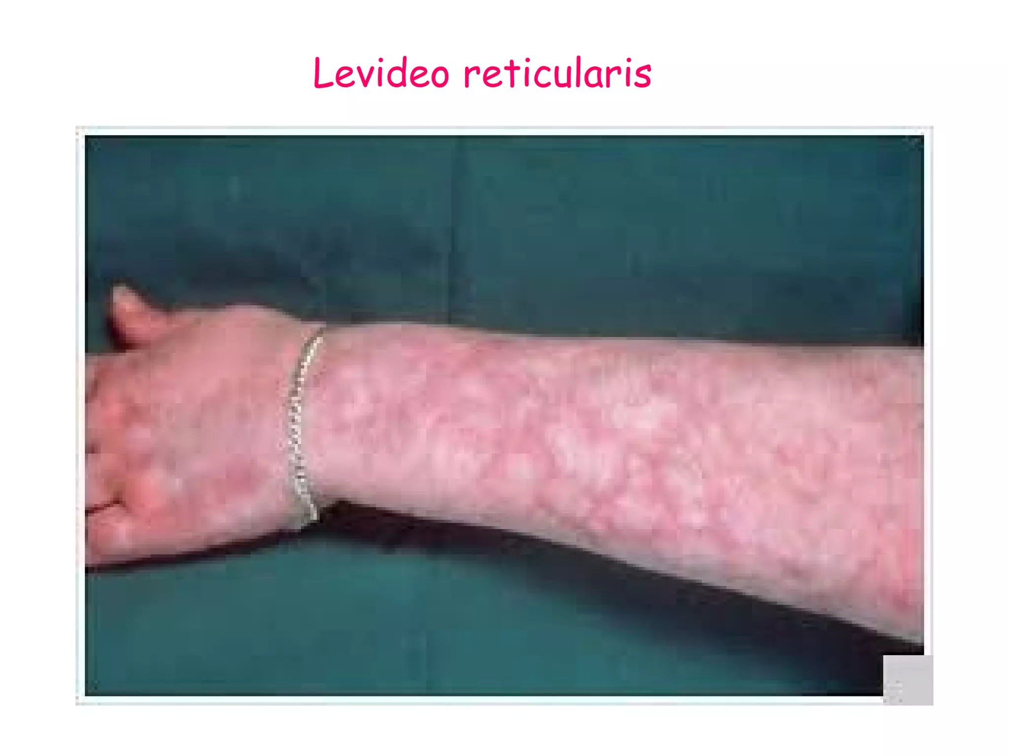 Antiphospholipid Syndrome | PPT