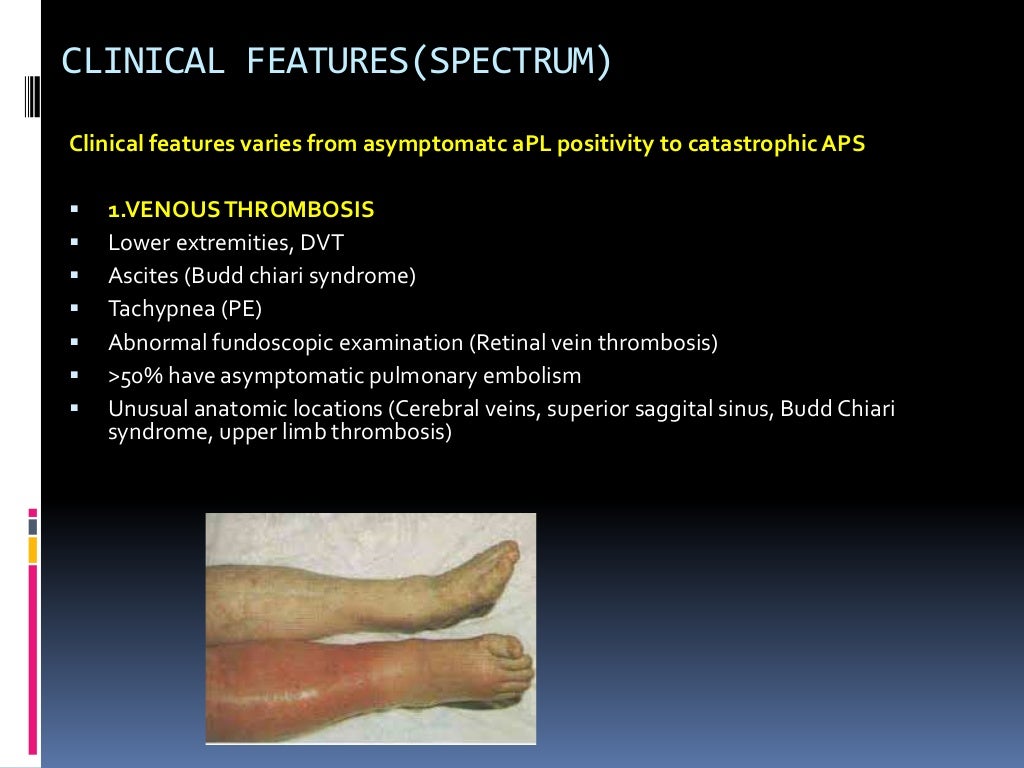 Antiphospholipid syndrome