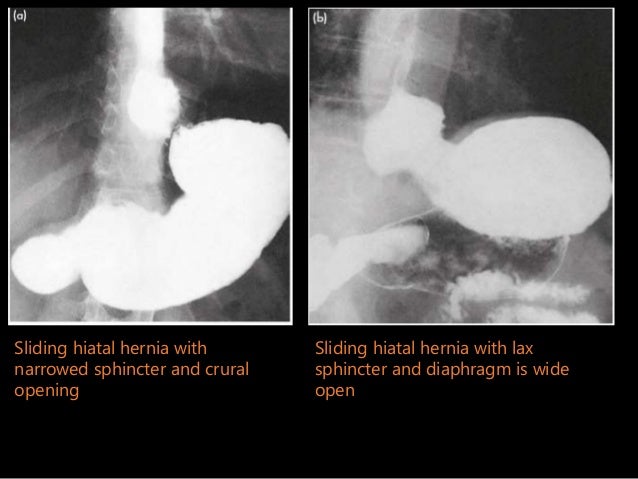Gastroesophageal Reflux Disease and Antireflux Surgery