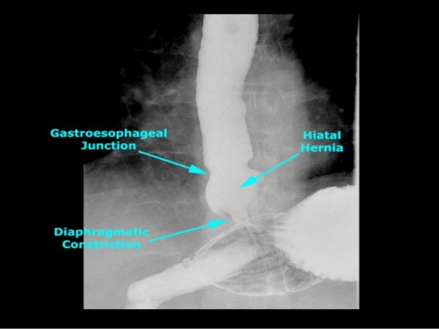 Gastroesophageal Reflux Disease and Antireflux Surgery