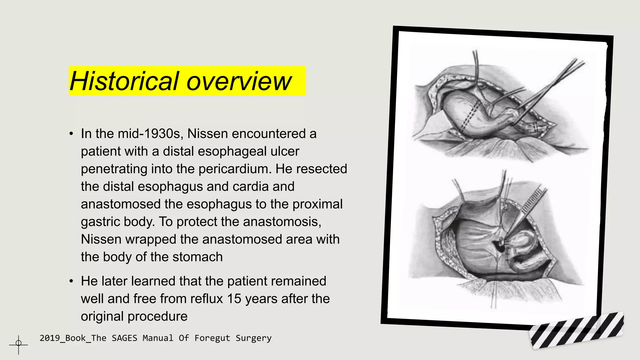 Anti reflux surgery [Autosaved].pptx