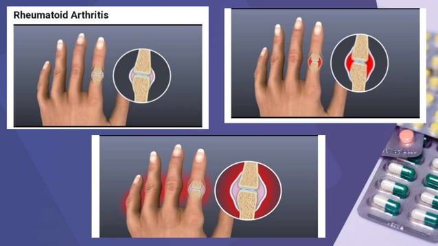 Anti rheumatic Drugs ,( Pharmacology ppt ) | PPTX | Bone and Joint ...