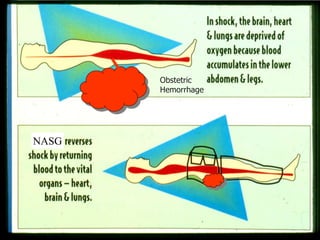 The use of antishock garment in Obs and gynae | PPT
