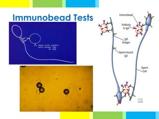 Antisperm antibody | PDF