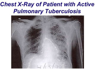 Antitubercular agents | PPT