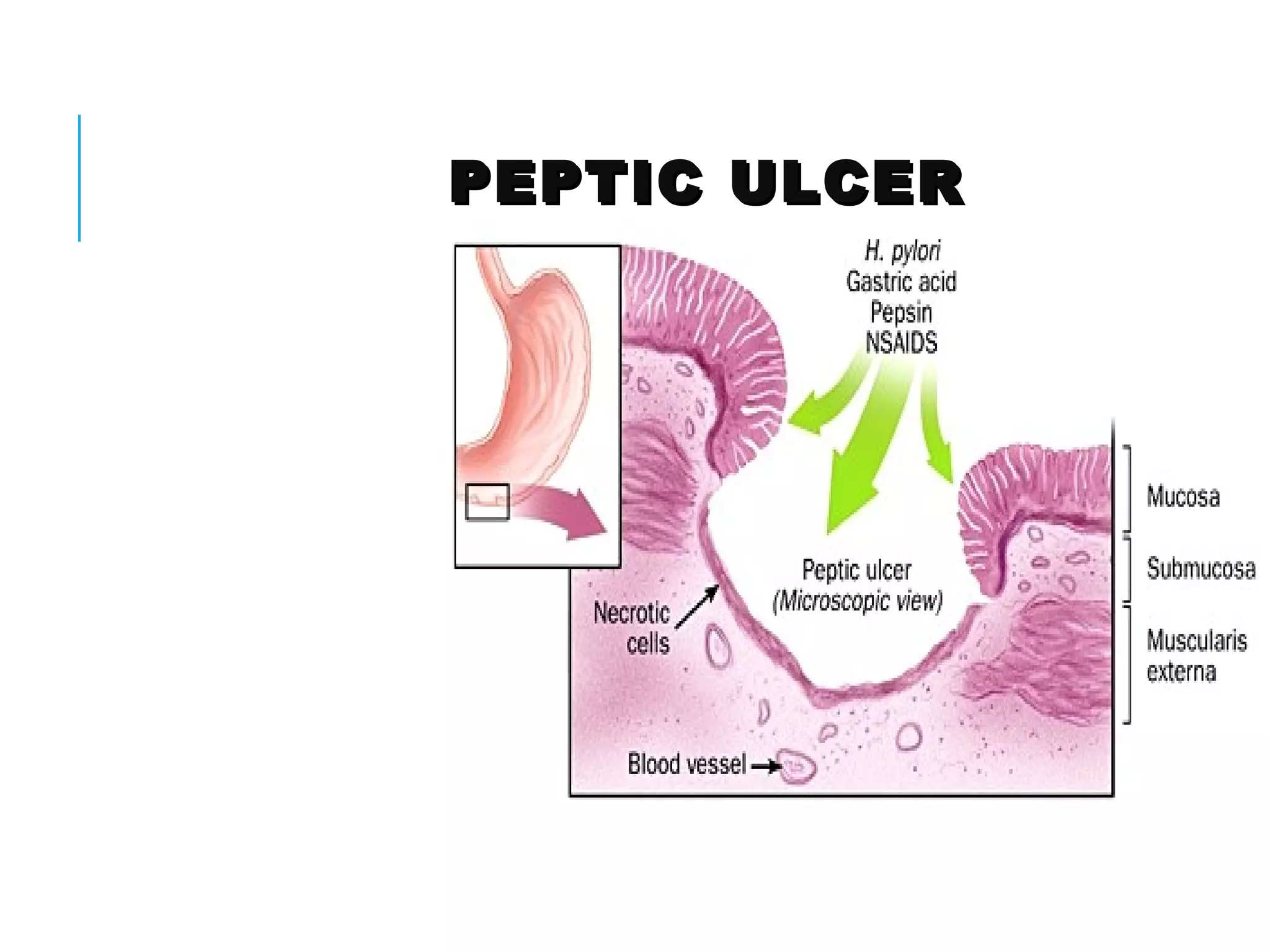 Pharmacology of anti ulcer drugs | PPT