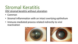 Anti-viral drugs in ophthalmic practice simplified | PPTX