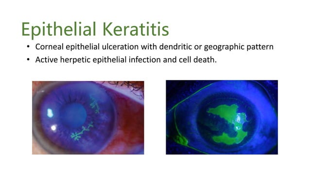 Anti-viral drugs in ophthalmic practice simplified | PPTX | Eye and ...