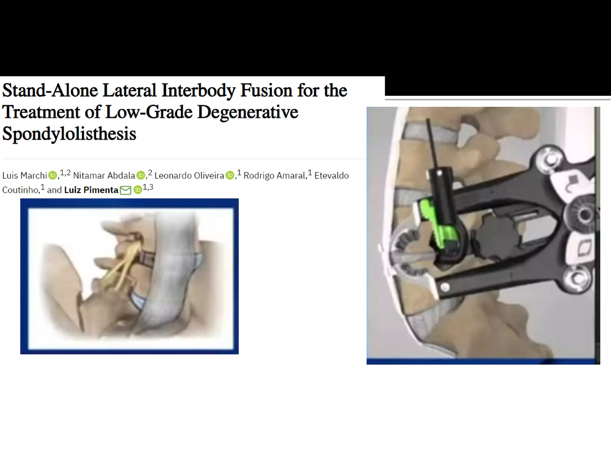 Anterior / lateral lumbar interbody Fusion | PDF