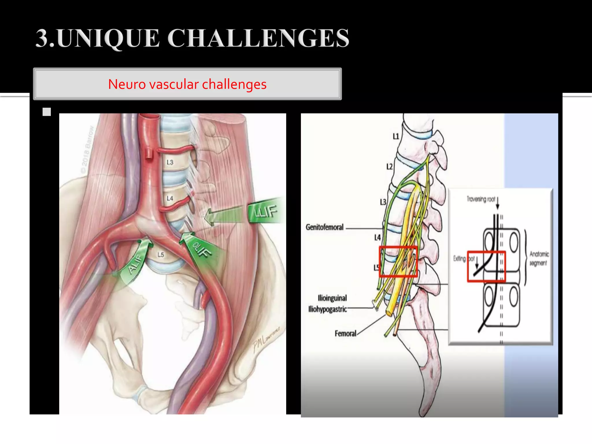 Anterior / lateral lumbar interbody Fusion | PDF