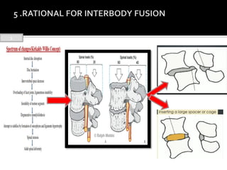 Anterior / lateral lumbar interbody Fusion | PDF