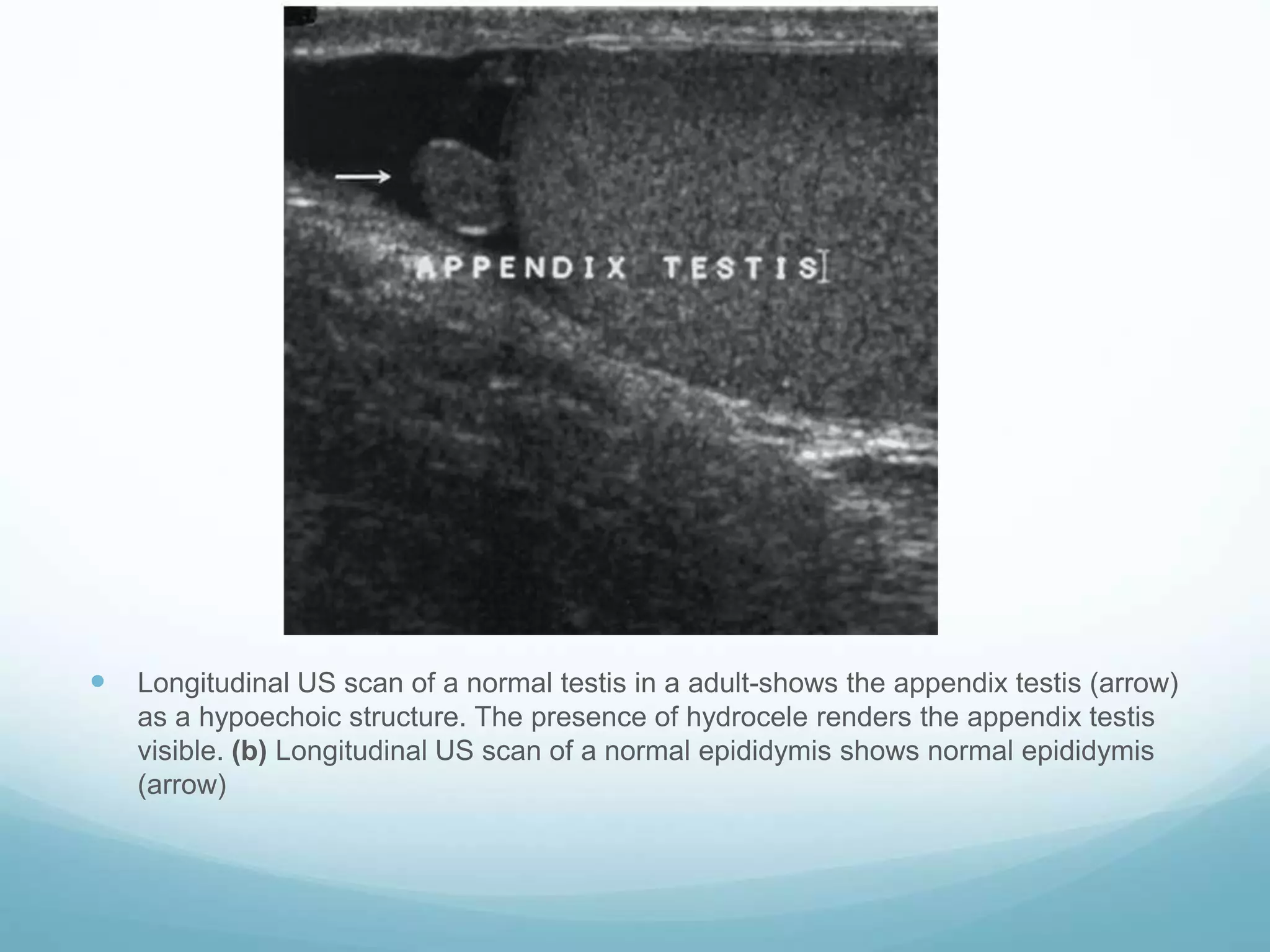 Antomy of scrotum and testis | PPTX