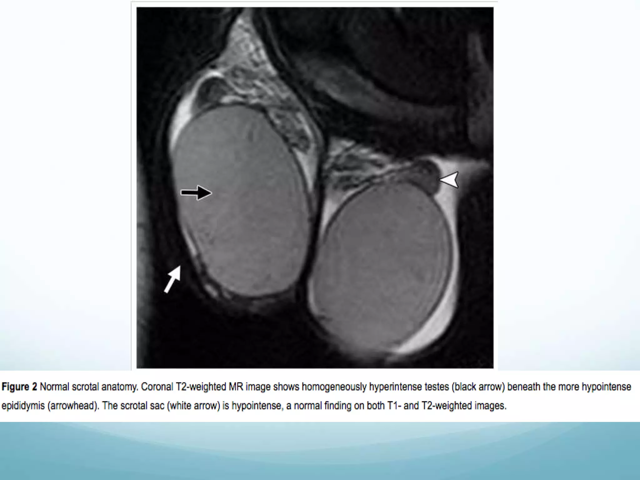 Antomy of scrotum and testis | PPTX