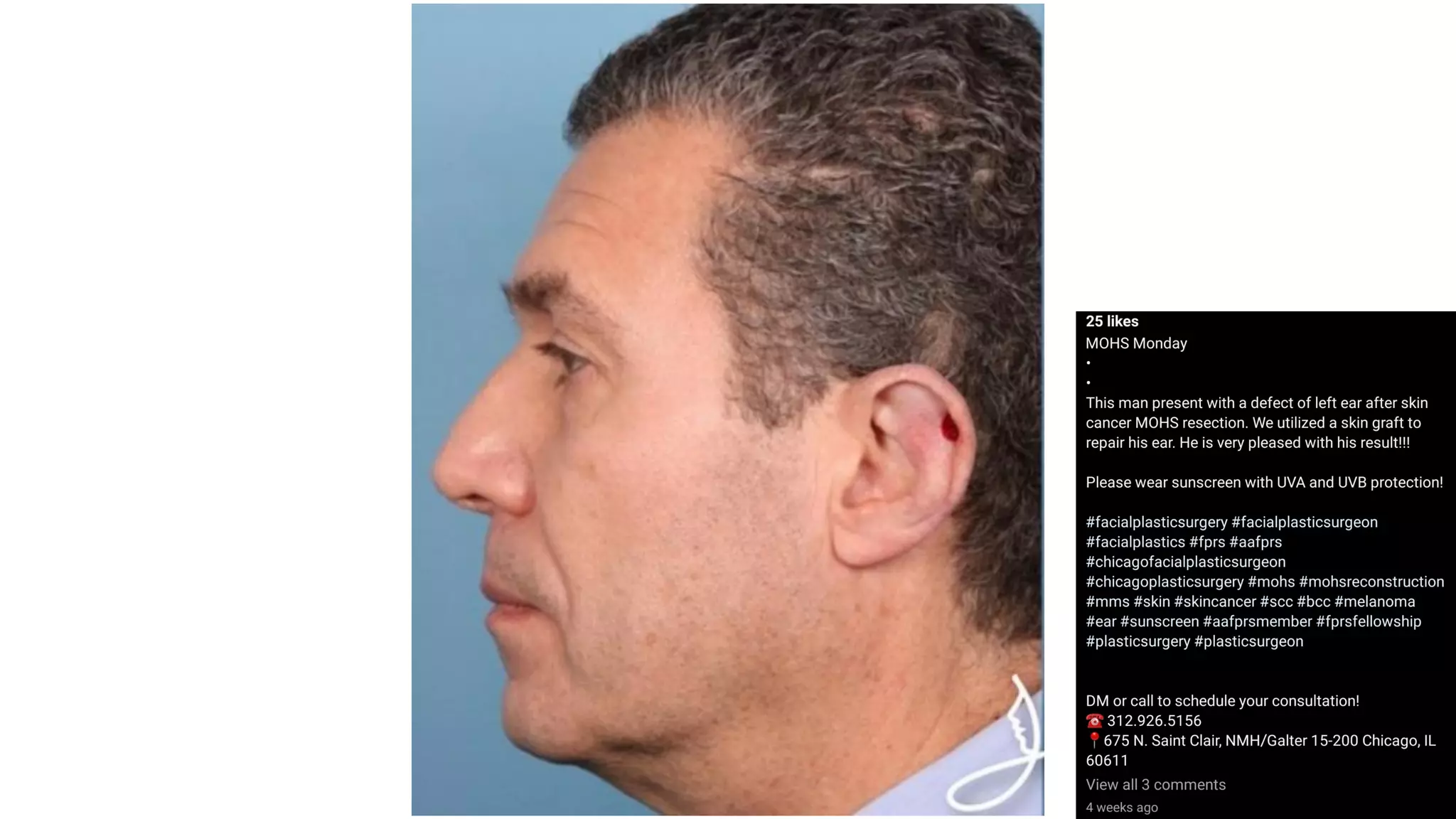 Antonio Romanucci Ear Surgery 2023 - MOHS surgery example | PPT