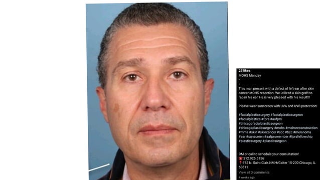 Antonio Romanucci Ear Surgery 2023 - MOHS surgery example | PPT