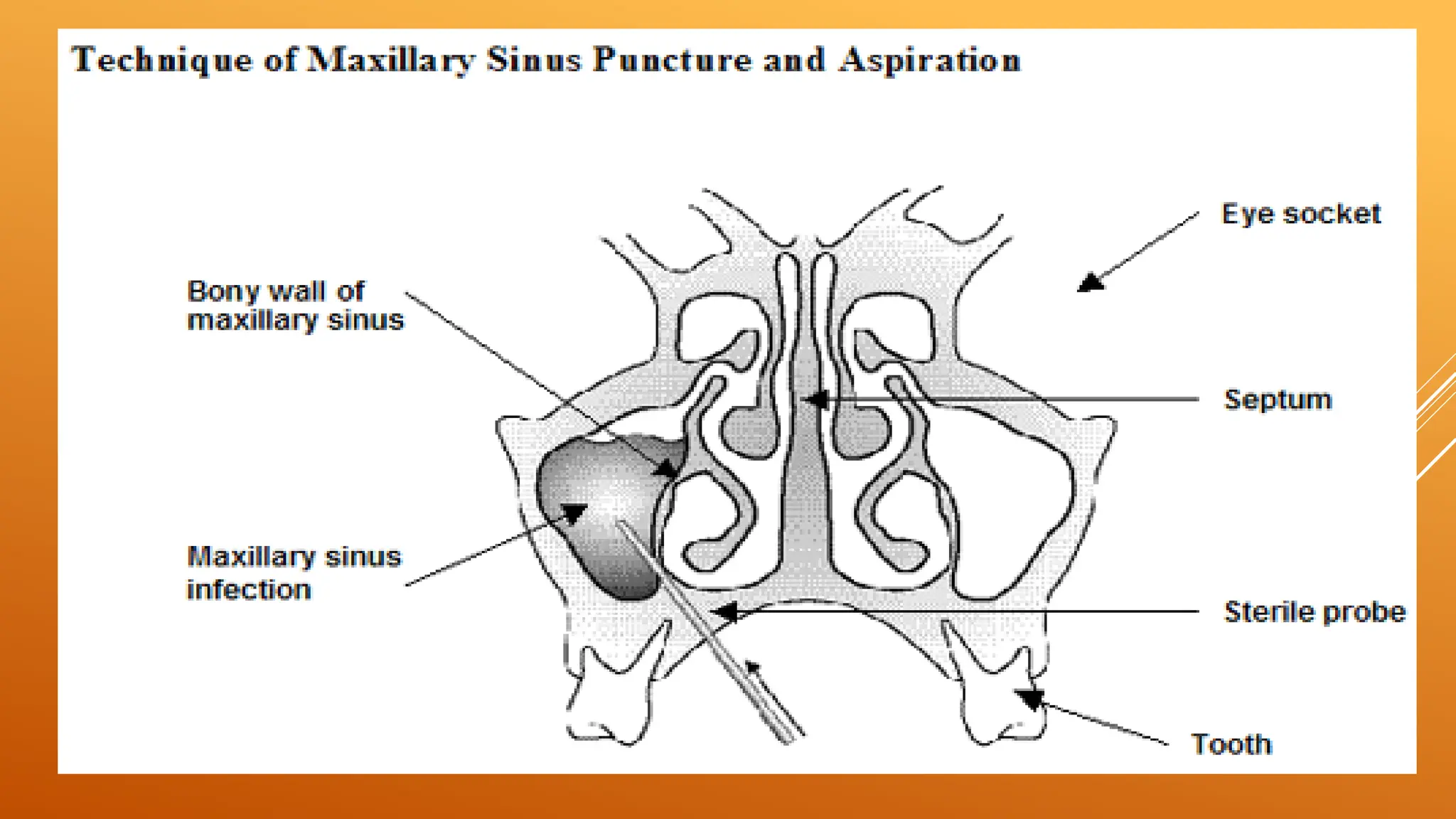 Antral Puncture and Sinus Lavage (Washout).pptx