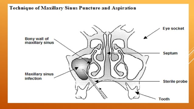 Antral Puncture and Sinus Lavage (Washout).pptx