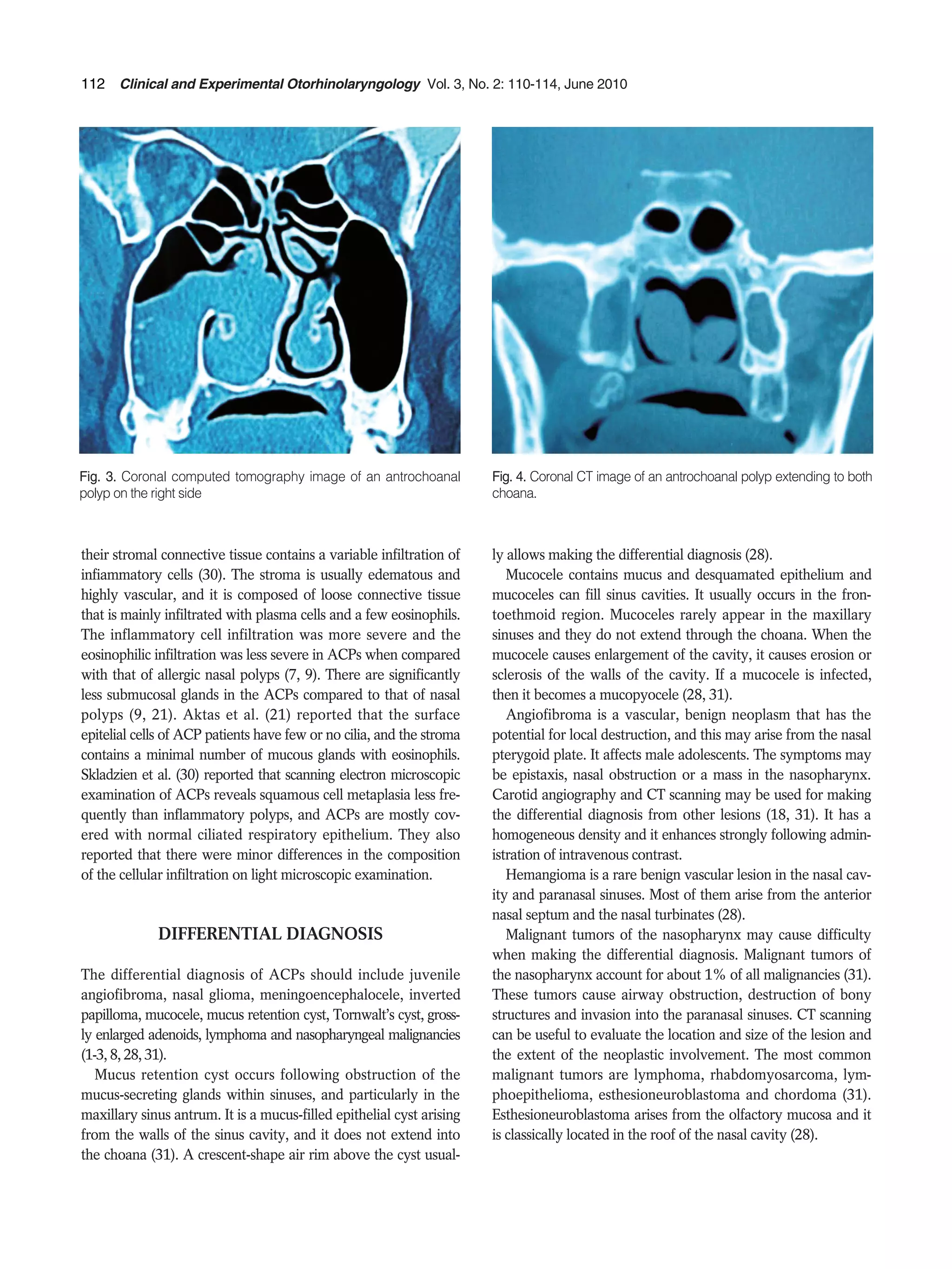 Antrochoanal polyp | PDF