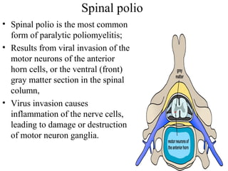 Poliomyelitis Spinal Cord