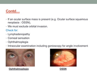 ANTERIOR SEGMENT EXAMINATION.PPTX....... | PPT