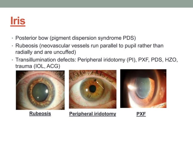 ANTERIOR SEGMENT EXAMINATION.PPTX....... | PPT