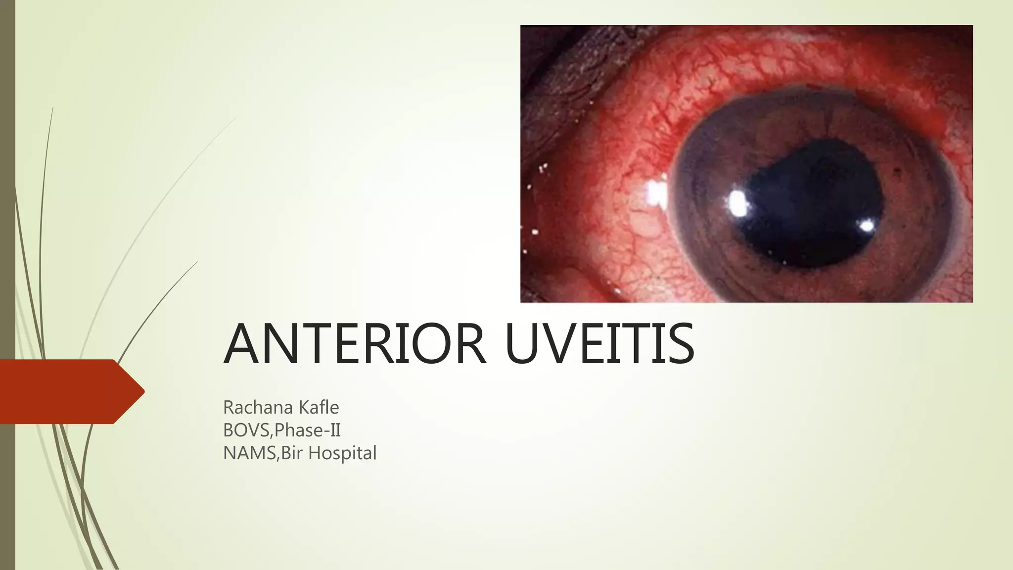 Anterior uveitis - SIGNS, SYMPTOMS AND TREATMENT | PPTX