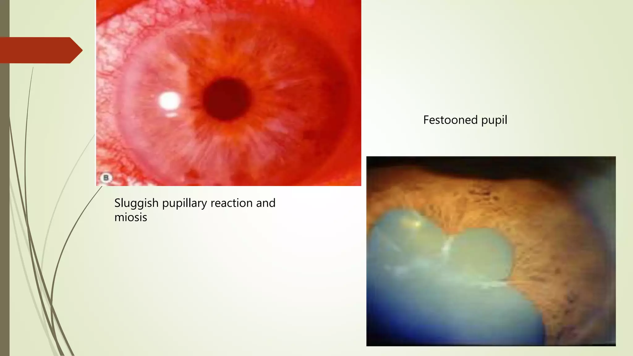 Anterior uveitis - SIGNS, SYMPTOMS AND TREATMENT | PPTX | Eye and ...