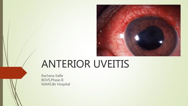 Anterior uveitis - SIGNS, SYMPTOMS AND TREATMENT | PPTX | Eye and Vision Conditions | Diseases ...