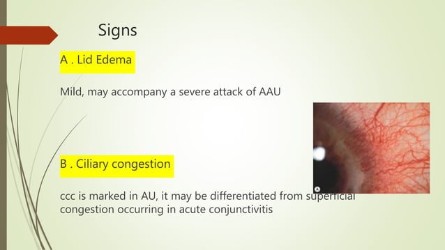 Anterior uveitis - SIGNS, SYMPTOMS AND TREATMENT | PPTX | Eye and ...